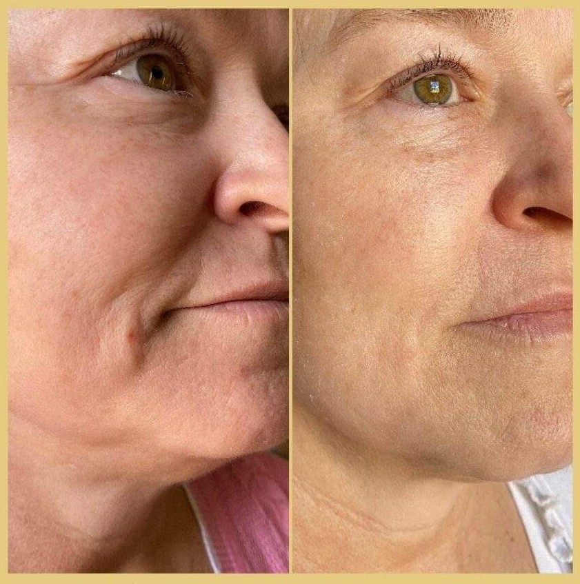 Jet Plasma - The Health & Beauty Clinic